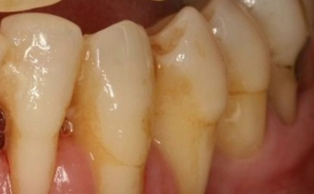 Periodontitis: Qué es y qué lo provoca - Caredental Albacete